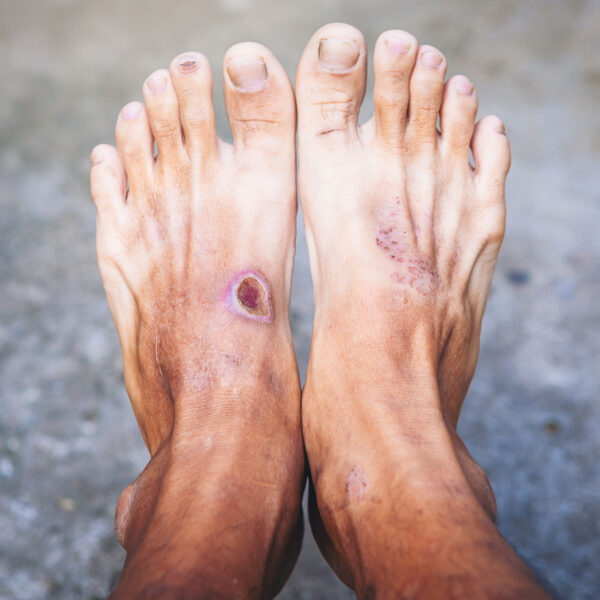 Foot Wound Care | Vale Foot and Ankle Surgery