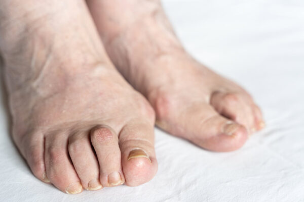 Hammertoes | Vale Foot and Ankle Surgery